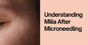 Itching After Microneedling? Quick Relief Guide