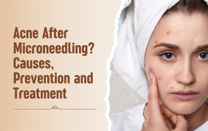 Itching After Microneedling? Quick Relief Guide